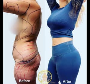 Tummy Tuck Recovery: Timeline, Tips, and Must-Haves