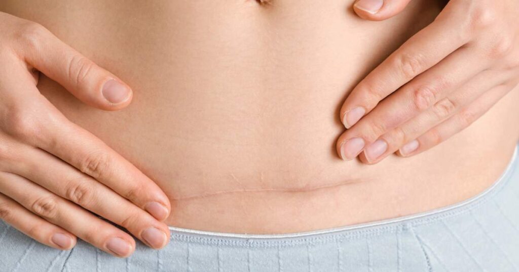 Tummy Tuck Recovery: Timeline, Tips, and Must-Haves