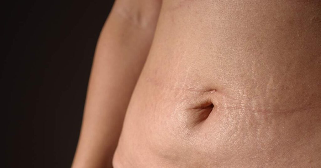 Tummy Tuck Recovery: Timeline, Tips, and Must-Haves