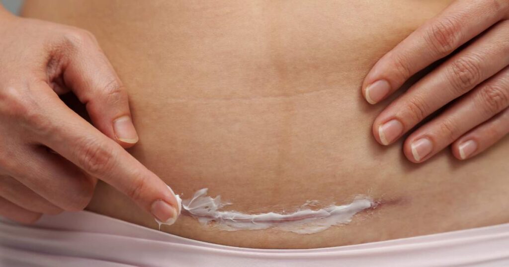 Tummy Tuck Recovery: Timeline, Tips, and Must-Haves