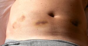 Tummy Tuck Recovery: Timeline, Tips, and Must-Haves
